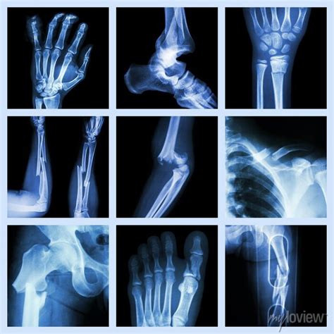 Collection Of Bone Fracture Posters For The Wall • Posters Forearm