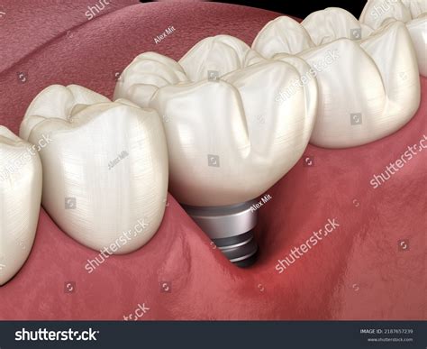 Peri Implant Mucositis Over 39 Royalty Free Licensable Stock
