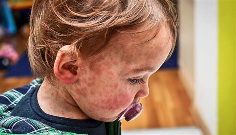 Measles Outbreak 2024