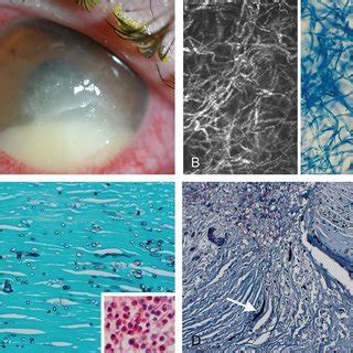 PDF Pythium Insidiosum Keratitis In Israel