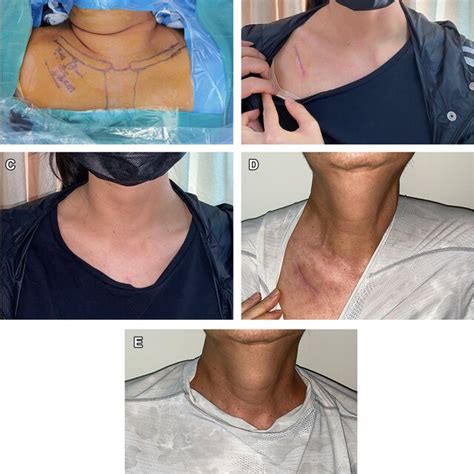 The Superior Neck Incision Of Gasless Endoscopic Thyroidectomy Via Download Scientific Diagram