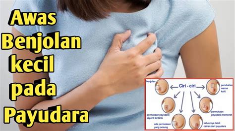 Menakjubkan Benjolan Pada Payudara Sembuh Dengan Cepat Tanpa Operasi HD YouTube