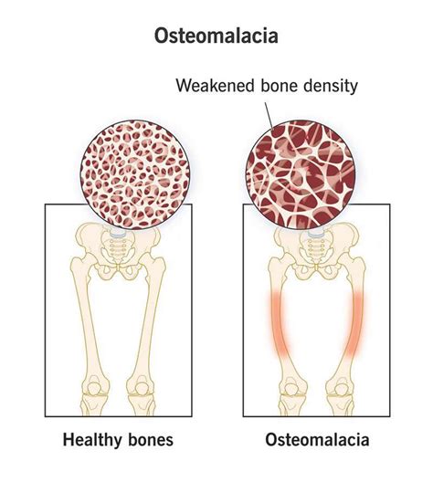 Osteomalacia What It Is Symptoms And Treatment Wockr