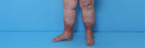 Lipodermatosclerosis Cosmetic And Veins Clinic