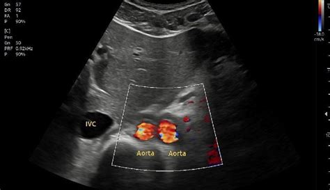 The Double Aorta Artifact A Benign Trap In Abdominal Sonography