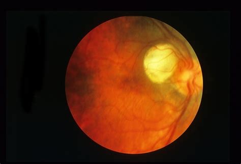 Cysticercus Toxocara Retina Image Bank