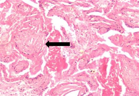 Funisitis Diffuse Neutrophilic Infiltration Around Umbilical Vessels