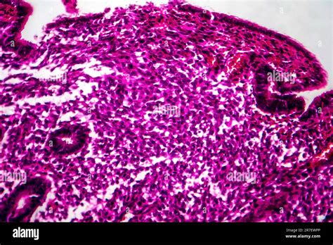 Endometriumhyperplasie Licht Schliffbild Einer Sektion Durch Gewebe Aus Dem Endometrium In