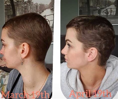 Chemotherapy Hair Loss Timeline
