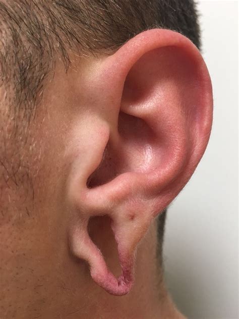 Wunderbare Otoplastik Von Extrem Gedehnten Ohrlöchern Estheticonde