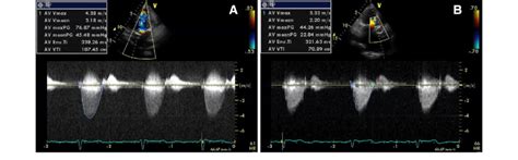 Pre And Post Procedural Transthoracic Echocardiography The Peak