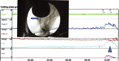 Primary Bladder Neck Dysfunction In A 46 Year Old Man With Chronic