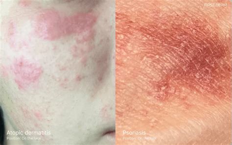 Eczema Atopic Dermatitis Vs Psoriasis Understanding The Differences First Derm