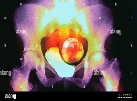 Uterine Fibroid Coloured Urogram X Ray Of The Pelvis Of A Patient