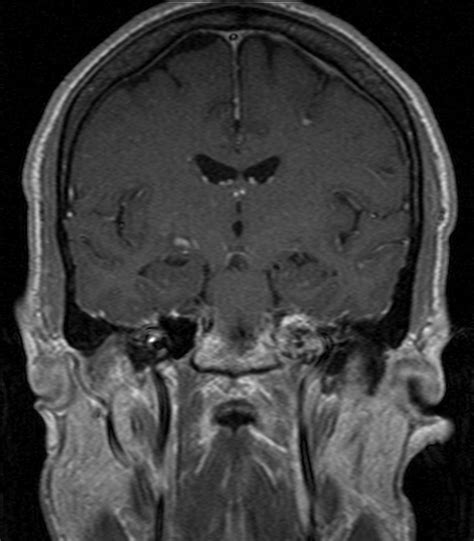 Cryptococcal Meningitis 2 6 Pinkybone
