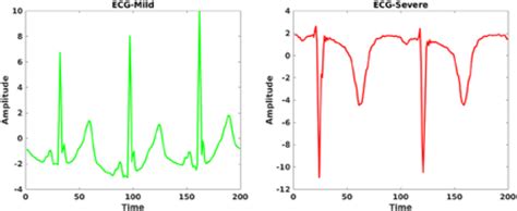 Example Of Ecg Waveforms Amplitude Versus Time From Two Randomly Download Scientific Diagram