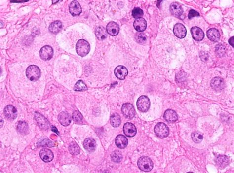 Pathology Outlines Steroid Cell Tumor