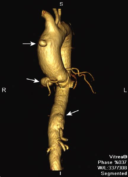 Ct Scan 3 D Reconstruction Showing Multiple Saccular Aneurysms