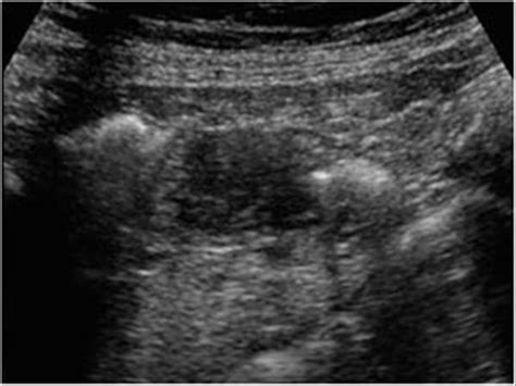 Abdomen And Retroperitoneum 1 8 Various Intra Abdominal Tumors Case 1 8 1 Various Malignant