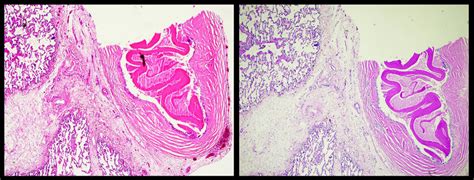 Atypical Partial Lung Excision Specimen Of The Right Medial Lobe With