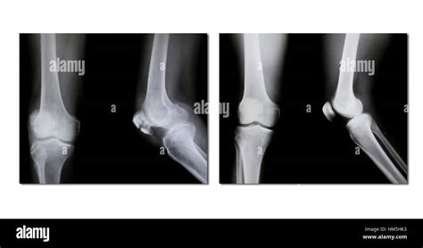 X Ray Broken Knee Knee Series Radiology Reference Article