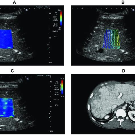 Two Dimensional Shear Wave Elastography 2d Swe Shear Wave Dispersion