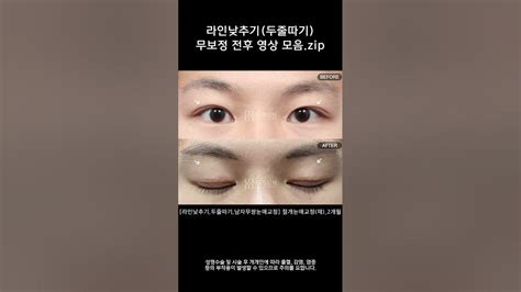 [shorts] 쌍꺼풀 라인낮추기 두줄따기 쌍수재수술 전후영상 모음 Zip 시선성형외과 시선성형외과 쇼츠 Youtube