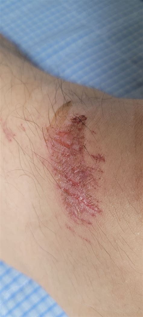 상처부위 감염됐을까요 지식in