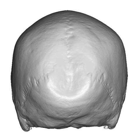 Plastic Surgery Case Study Custom Skull Implant For Correction Of