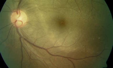 Retinal Syphilis And Tuberculosis