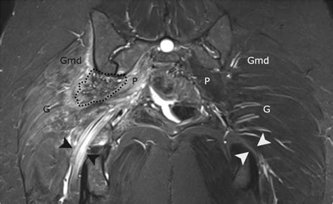 Sciatic Foramen Mri