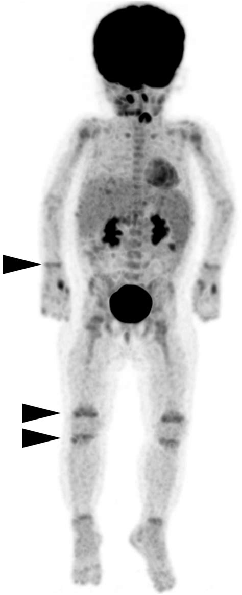 Multimodality Imaging Of Bone Marrow Involvement In Paediatric Oncology