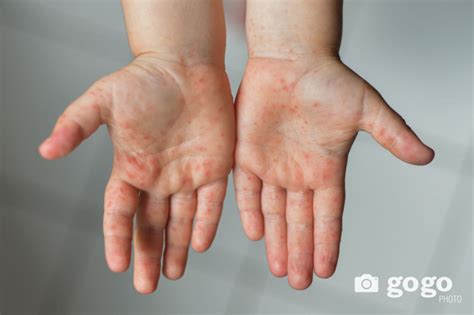 Улаанбурхан өвчний 7 дахь тохиолдол лабораториор батлагдлаа