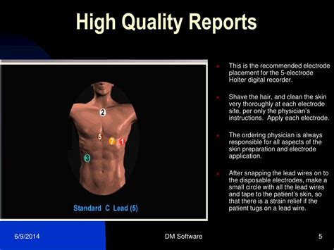 Ppt Reading The Holter Ecg Report Powerpoint Presentation Free