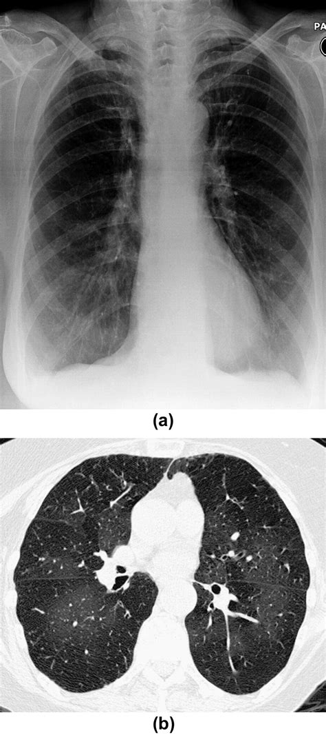 Thoracic Complications Of Rheumatoid Disease Clinical Radiology