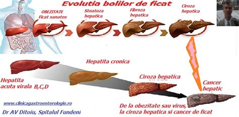 Ciroza Hepatica Boala Nevindecabila 0758 751 841