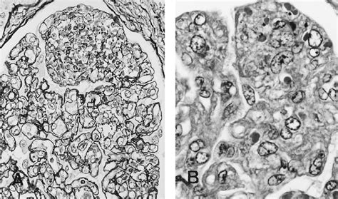 Mesangiolysis And Marked Cell Swelling A At The Top Of The Section Download Scientific