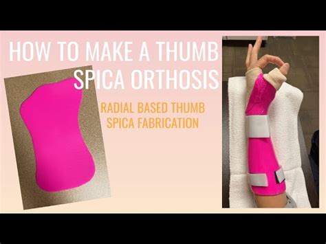 Radial Gutter Splint Pattern