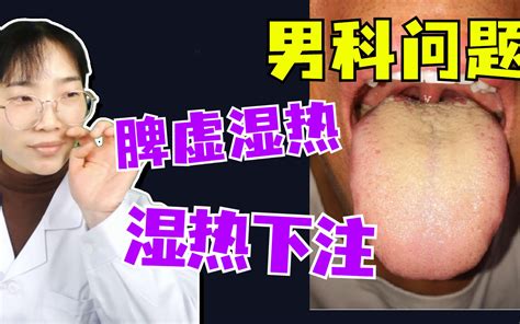 舌诊实战脾虚湿热湿热下注男科问题1个中成药及时调 哔哩哔哩