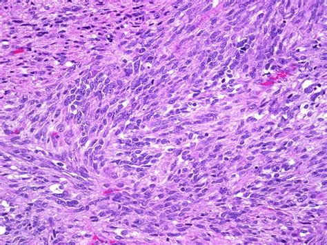 Mullerian Adenosarcoma With Sarcomatous Overgrowth
