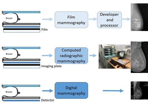 Atlas Of Breast Cancer Early Detection