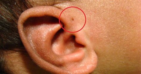 Only A Few People In The World Have This Tiny Hole Heres Why
