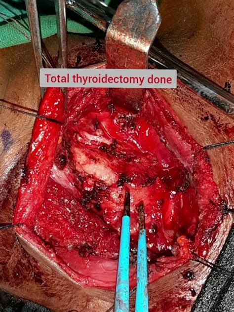 Multinodular Goitre Thyroid Swelling Total Thyroidectomy Surgical