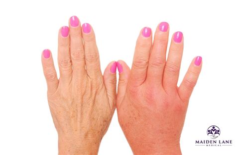 Ways To Reduce Swelling Maiden Lane Medical NYC