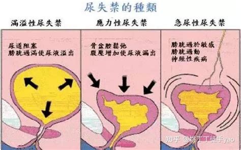盆底肌之尿失禁（压力性尿失禁、漏尿） 知乎