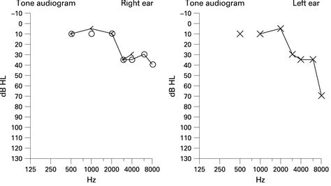 Aminoglycoside Ototoxicity Susceptibility In Cystic Fibrosis Thorax