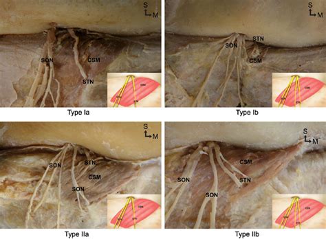 Structure Of Supratrochlear Nerve Semantic Scholar