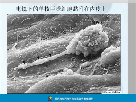 动脉粥样硬化病理图谱 Word文档在线阅读与下载 无忧文档