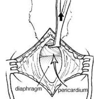 Pericardial Window Procedure Steps