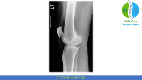 Patellar Dislocation